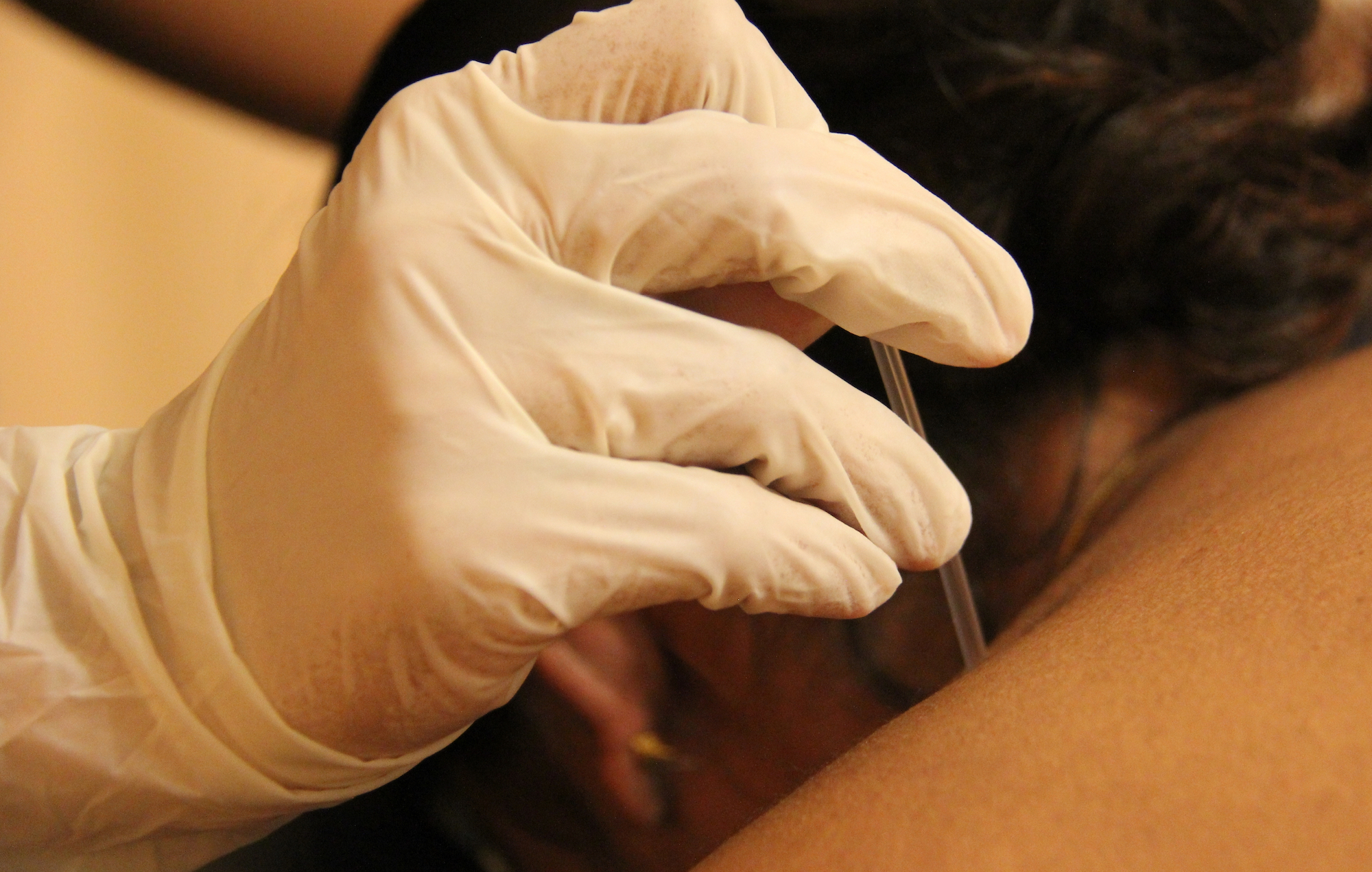 Dry Needling - Ropheka Physiotherapy & Sports Injury Centre